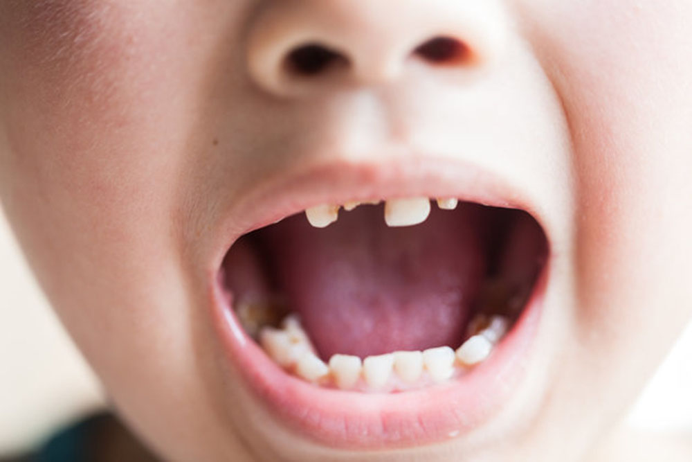 Children Teeth Decay